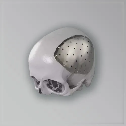 cranial implant,3d printing prosthesis,3d printing medical