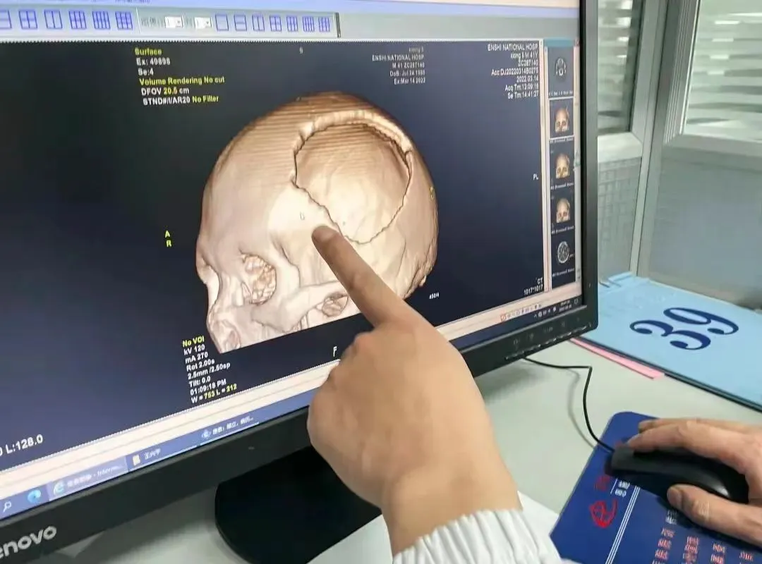 How to repair skull injuries using 3D printed PEEK implants
