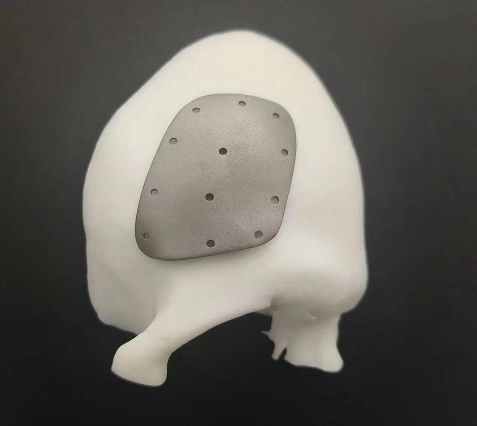 3D Printing Titanium Mesh for Cranial Repair – Example 6