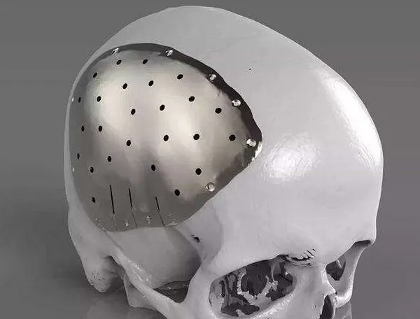 3D Printed Titanium cranial plates: A New Approach to Cranial Repair