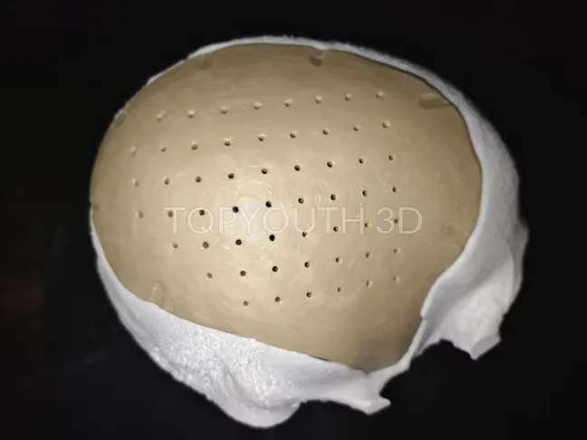 3D Printed Prosthesis: Selection of Cranial Repair Materials