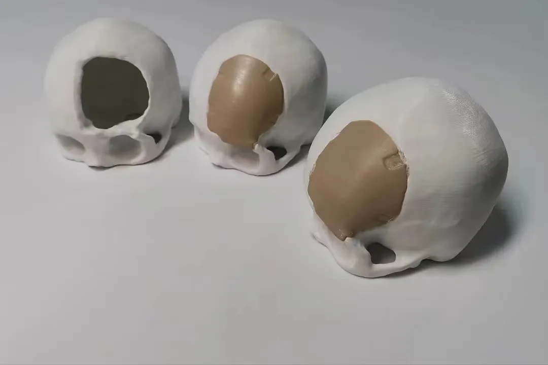 3D Printing PEEK: A New Direction for Skull Restoration