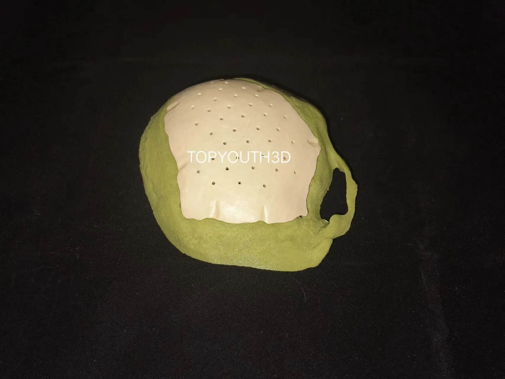 How to repair skull injuries using 3D printed PEEK implants