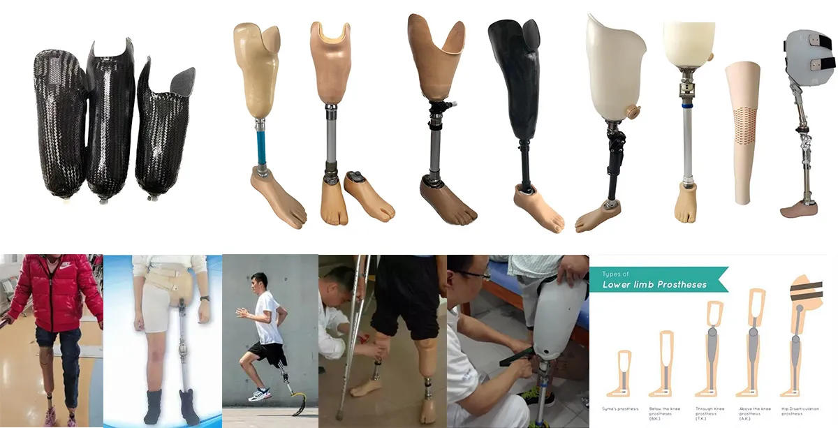 Custom Prosthetic Solutions