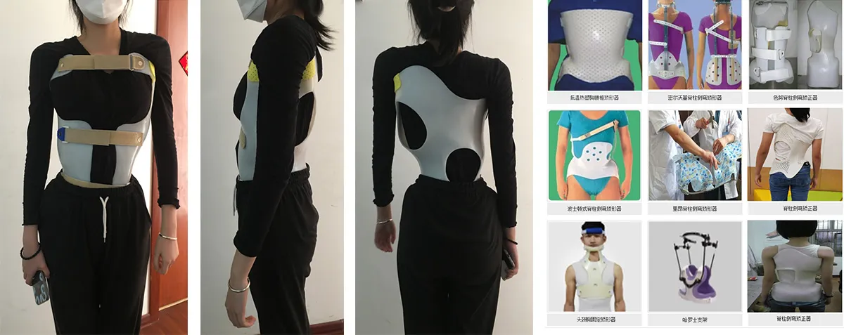 Custom Prosthetic Solutions