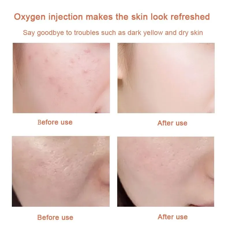 oxygen-injection-instrument