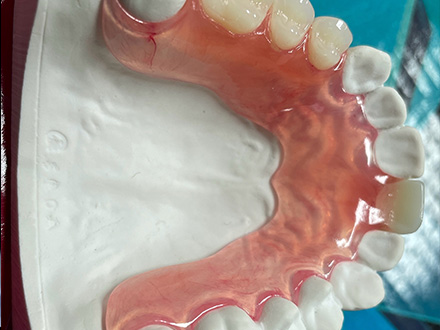 How long do Valplast dentures last?