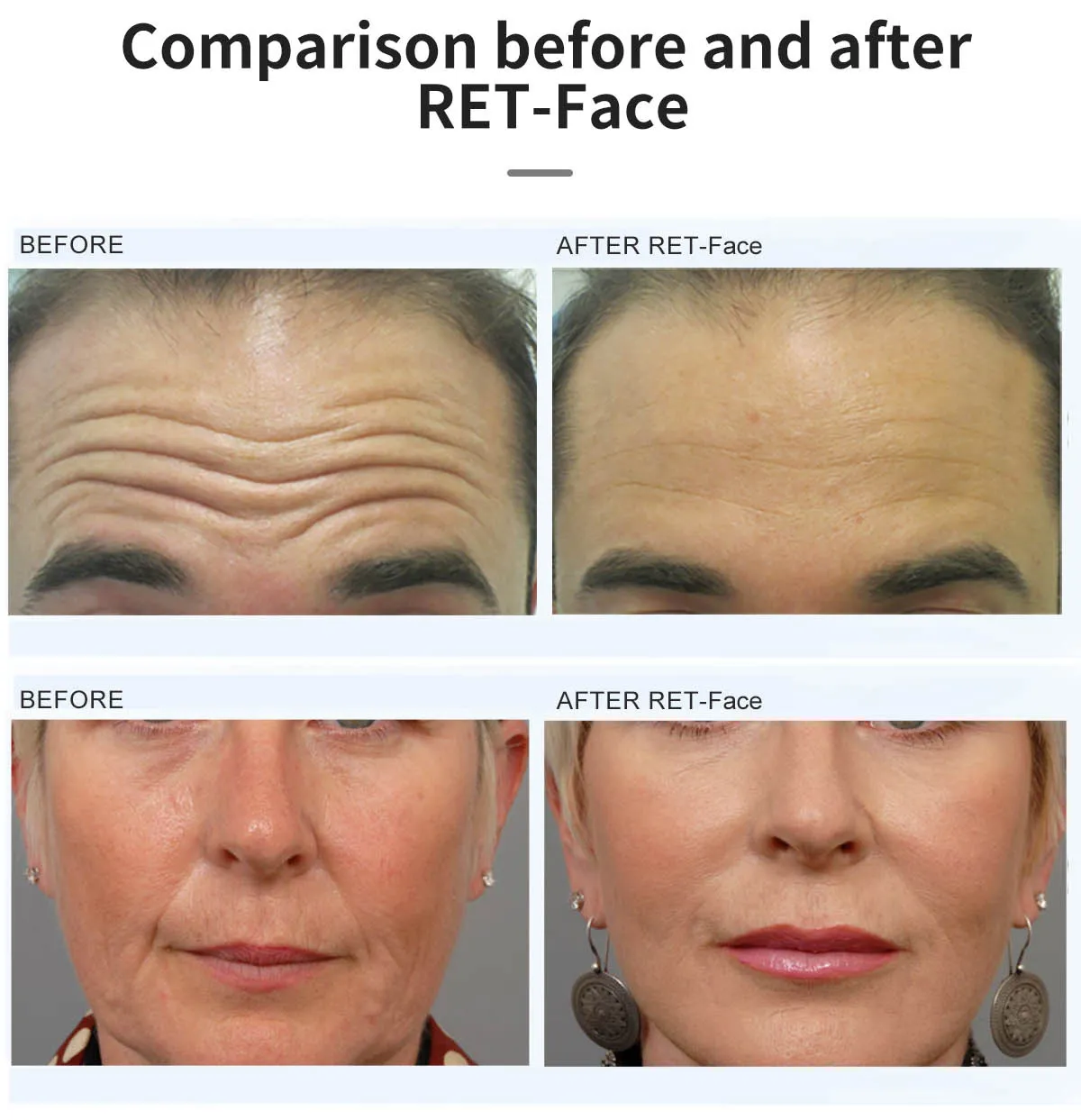 RF EMS PE-Face Muscle Face Machine for Face Care