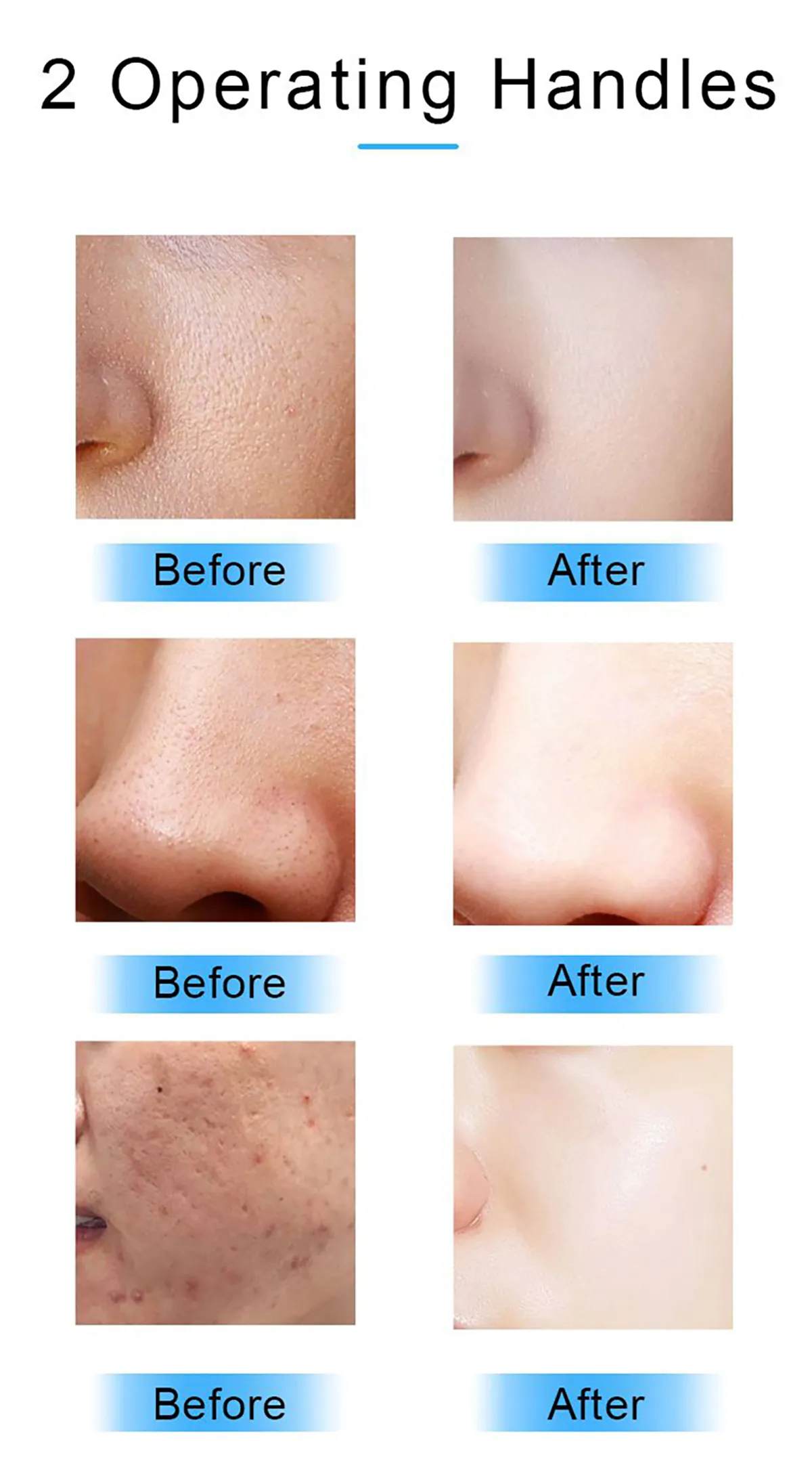 2 in 1 Gold RF Skin Rejuvenation fractional microneedling machine