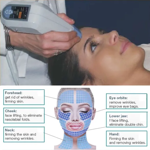 Exili ultra 360 RF skin tightening radio frequency machine