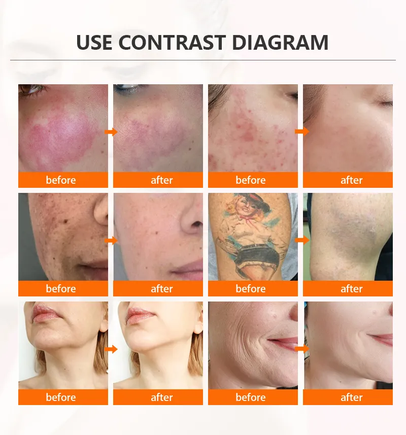 Picosecond Laser Beauty Machine for Skin Rejuvenation