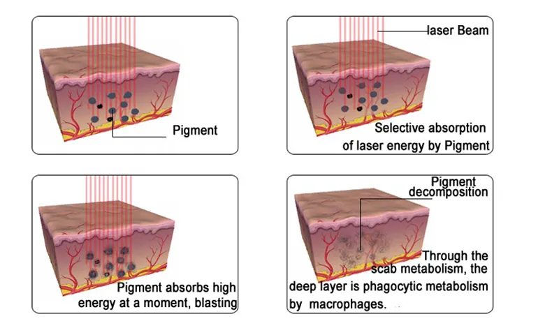Picosecond Laser Beauty Machine for Skin Rejuvenation
