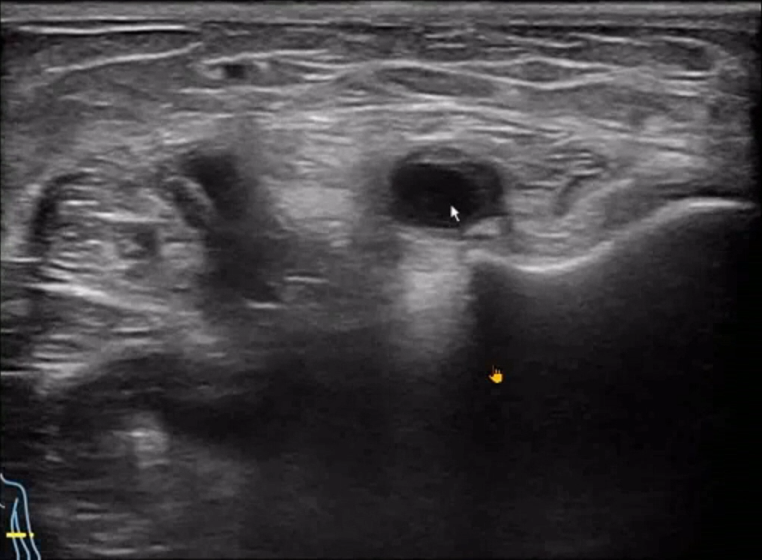 Utilizing Handheld Ultrasound for MSK Case Studies in Wrist