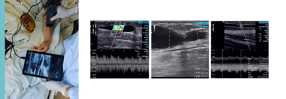 Handheld Ultrasound for Vascular Access: How SonoEye Enhances Precision ...