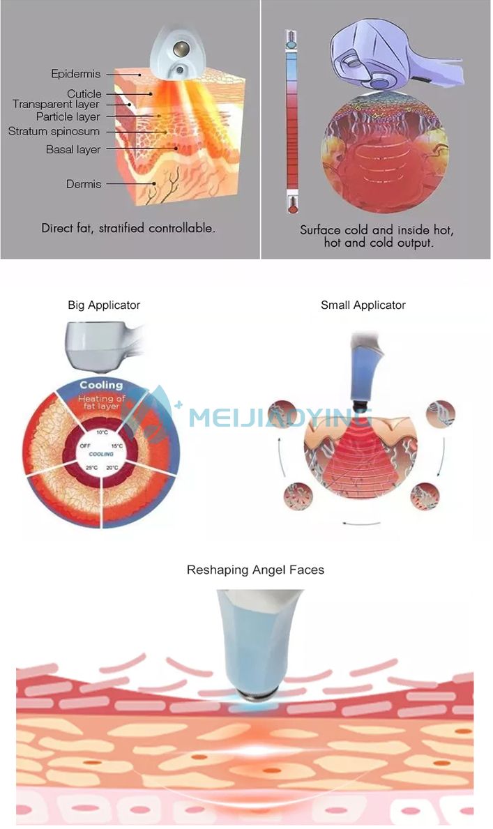 Ultra 360 Exilis Elite Skin Tightening Device