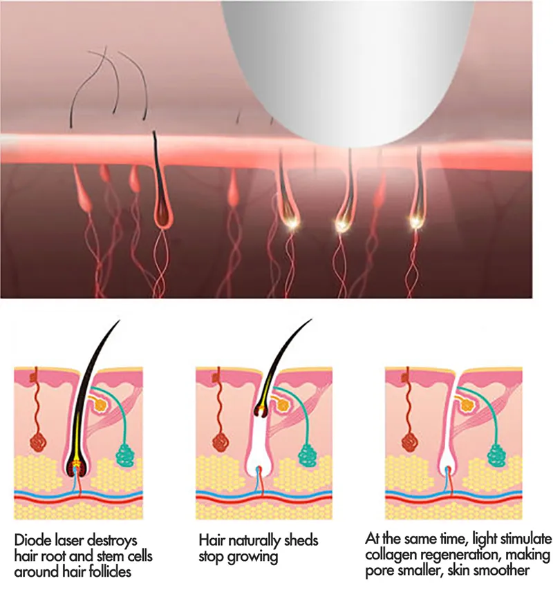2024 Latest 2000W Diode Laser Hair Removal with Hair Scan System