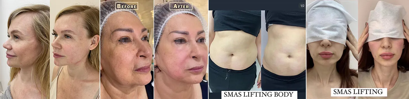 HIFU SMAS Skin Lifting and Tightening Anti-Aging 3 In 1 Machine