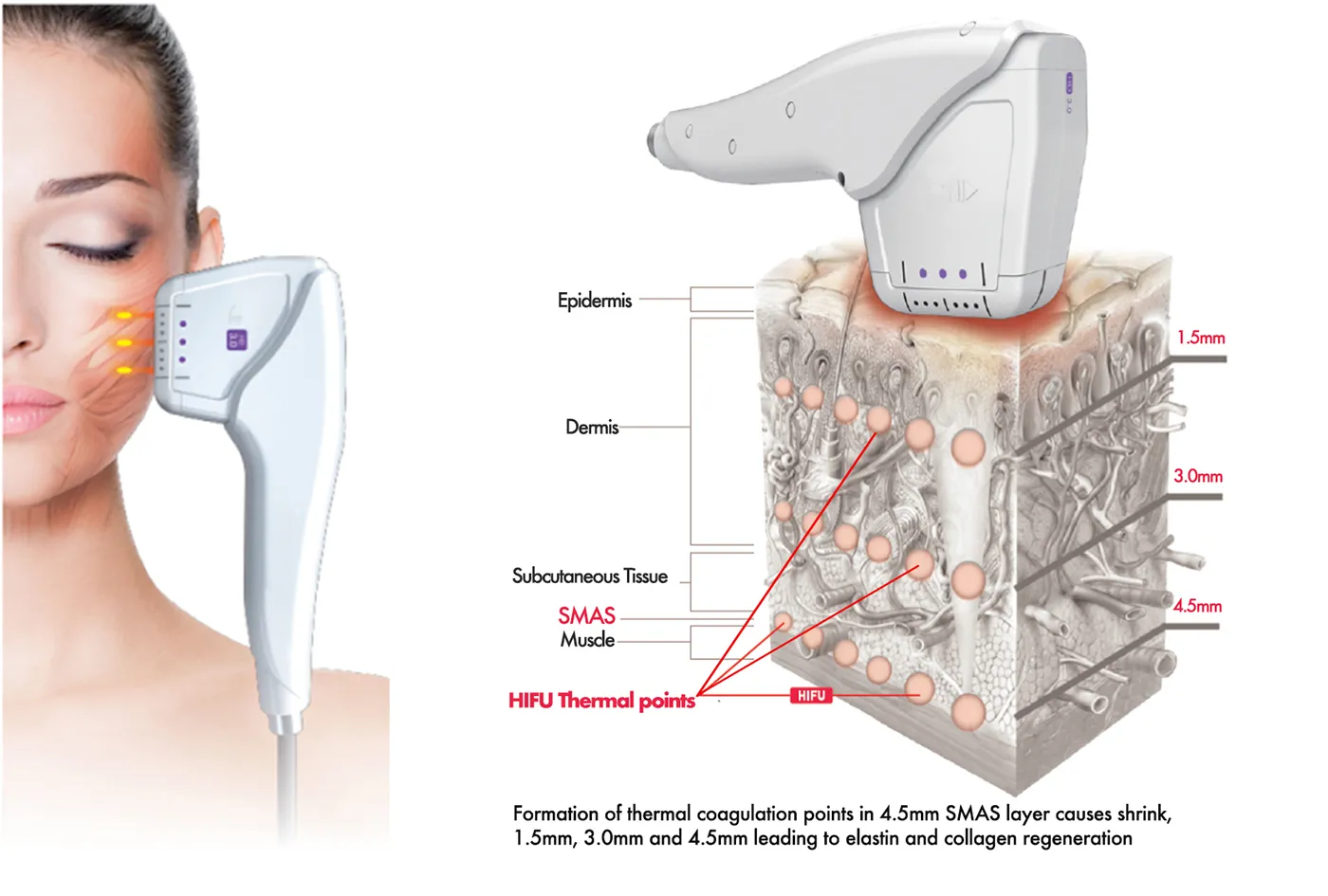 HIFU SMAS Lifting Microneedling Vaginal Tightening 3 in 1 Machine