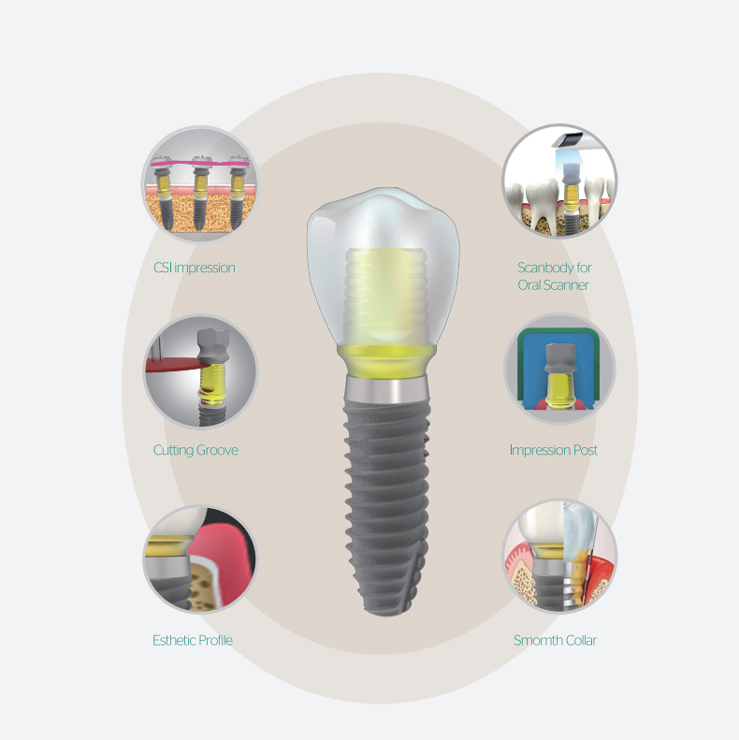 iEZ Dental Implant System