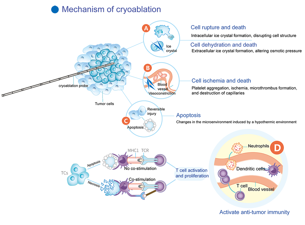 Cryoablation therapy process