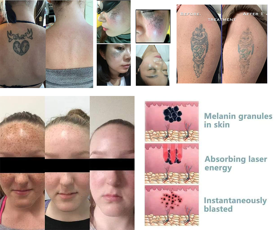 Pico Laser treatment before and after