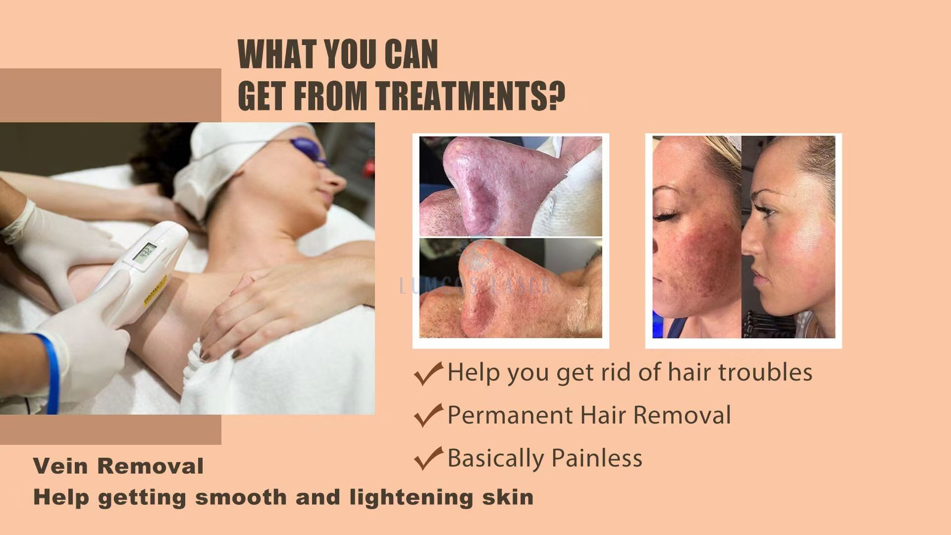 IPL, IPL skin Rejuvenation