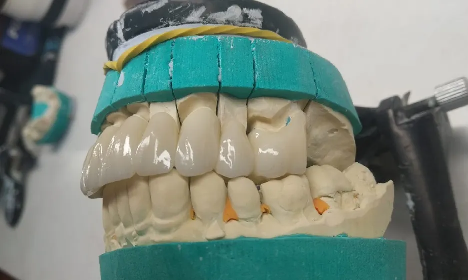 Points of Zirconia Crown Preparation Design