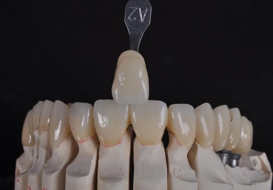 Points of Zirconia Crown Preparation Design